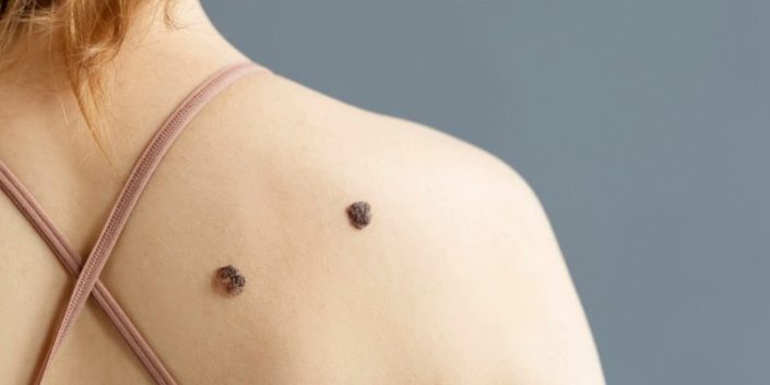 L’essentiel À Savoir Sur Les Grains De Beauté Qui Grattent